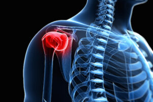 Kurwadziwa kwepafudzi mutennis: Chii, nei kuchiitika, maitiro ...